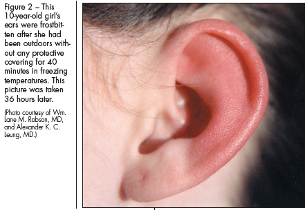 Frostbitten Human Ears